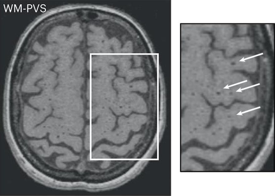 A large study reveals new mechanisms of cerebral small vessel disease ...
